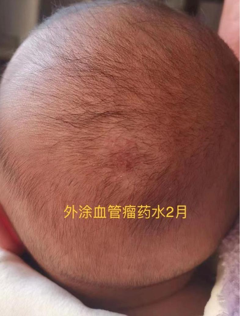 表浅型血管瘤外涂药水治疗，简单、安全、有效 微医（挂号网）
