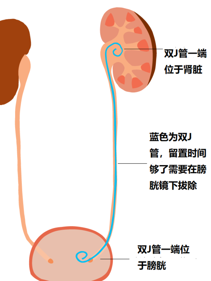 身体内放置双j管，有哪些注意事项？ 微医（挂号网）