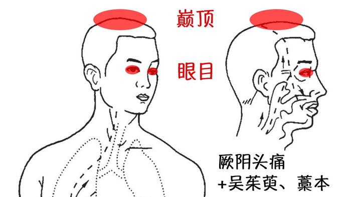头痛名方逐一看——吴茱萸汤 微医（挂号网）