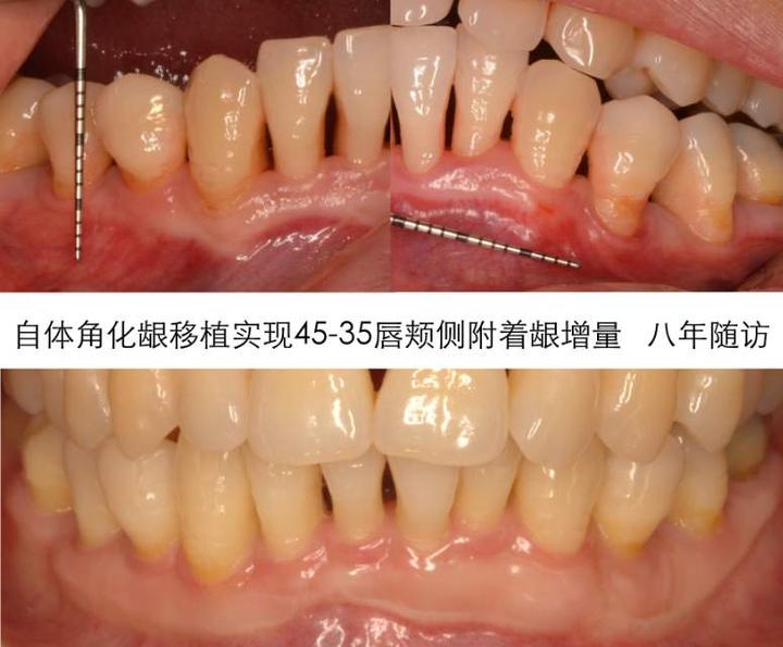 牙龈萎缩患者的手术治疗，一例重度牙周炎的角化龈增量 微医（挂号网）