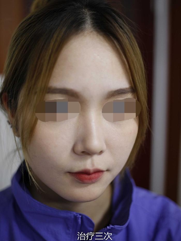 额头缝针疤痕修复案例 微医（挂号网）