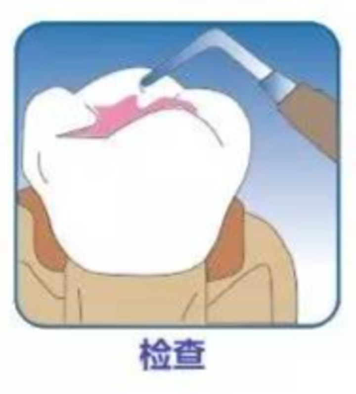 窝沟封闭，预防龋齿 微医（挂号网）