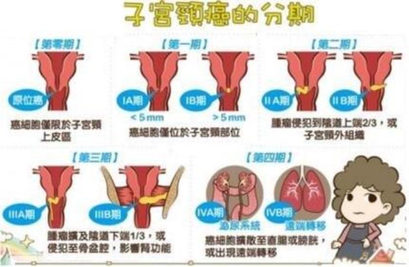 宫颈癌早期症状有哪些？如何治疗？ 微医（挂号网）