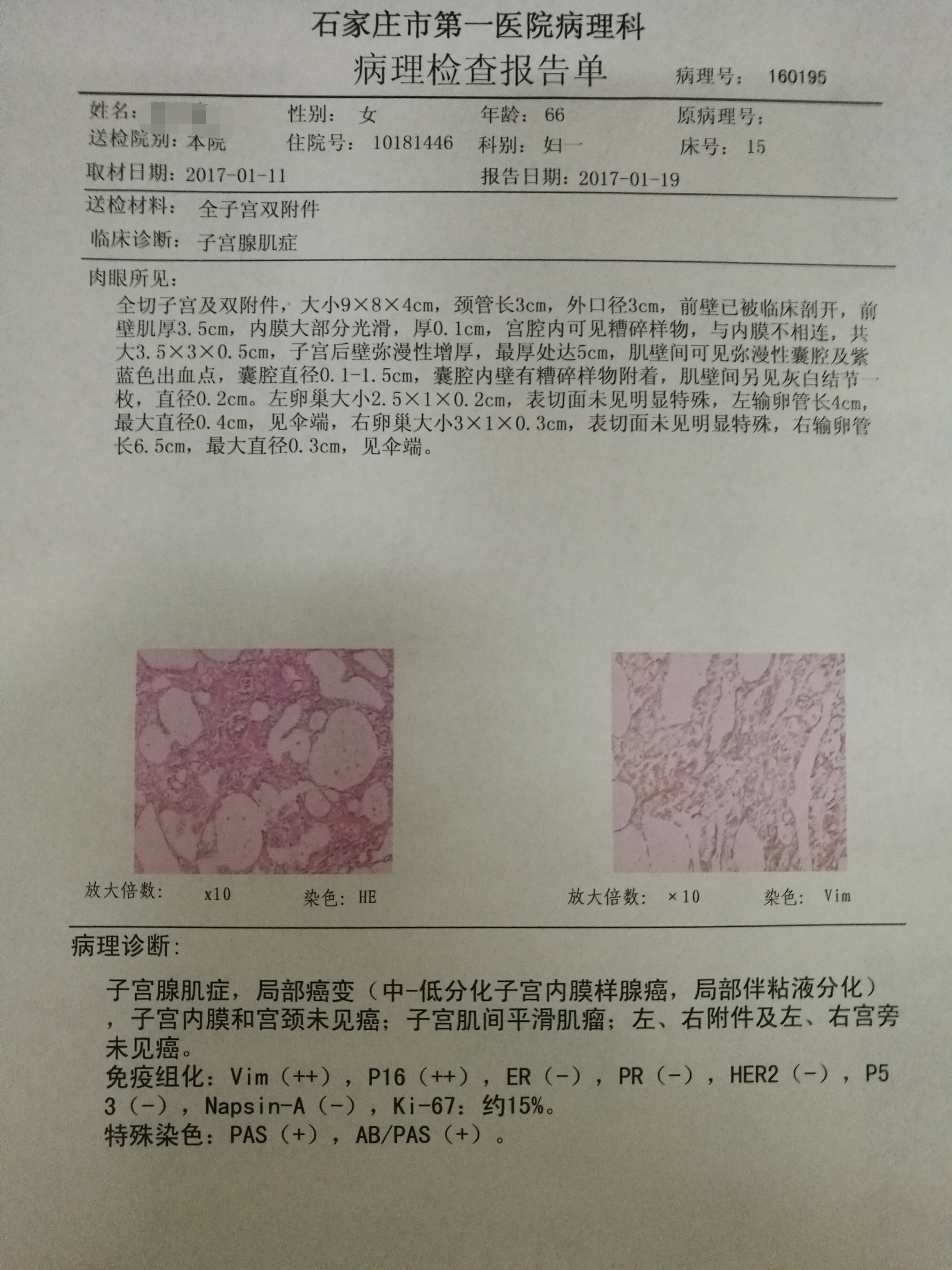 病历分享：子宫腺肌病恶变一例报告 微医（挂号网）