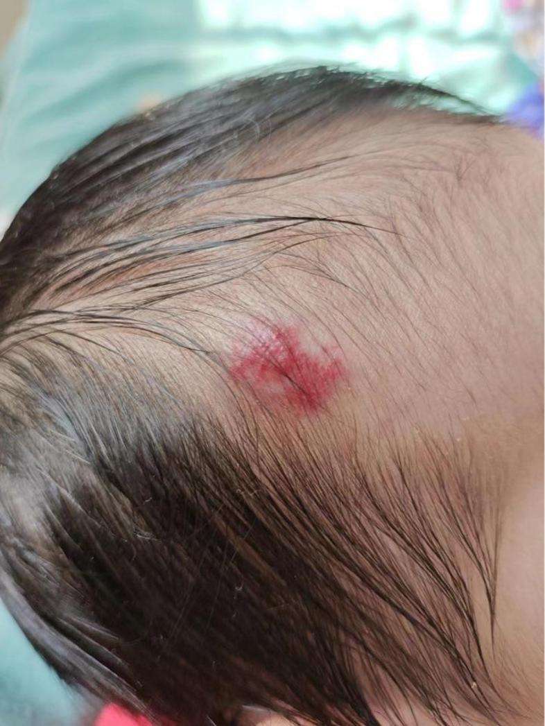 表浅型婴幼儿血管瘤外涂药水or药膏治疗 微医（挂号网）