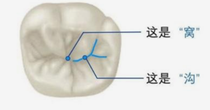 窝沟封闭，预防龋齿 微医（挂号网）