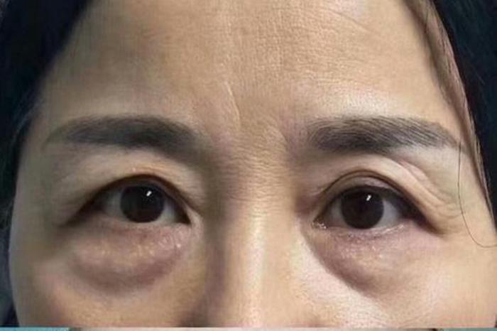 上眼睑皮肤松弛怎么处理 微医（挂号网）