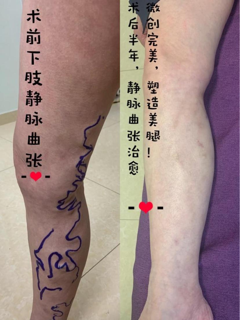 下肢静脉曲张优选方案— 腔内微波消融闭合术”《一站式治疗》 微医（挂号网）