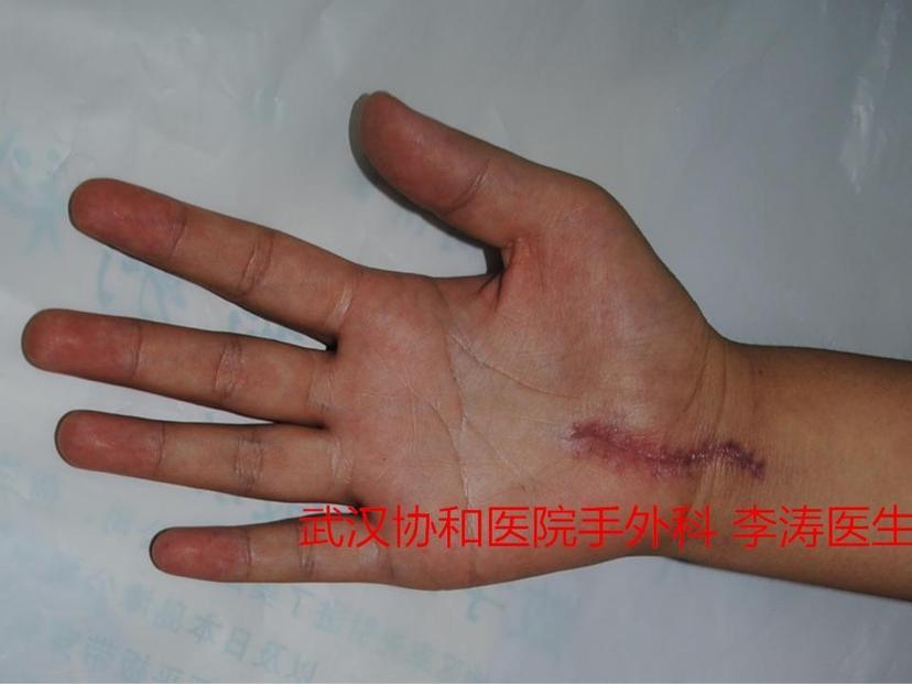 微创小切口治疗腕管综合征与传统长切口的优势比较 微医（挂号网）