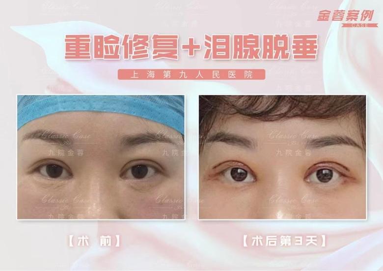 别再盲目做双眼皮了！这几种情况需及时修复！ 微医（挂号网）