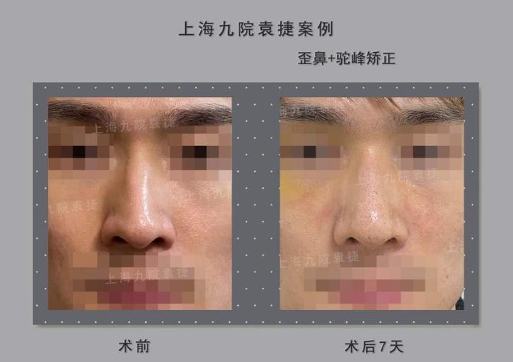 歪鼻矫正，驼峰鼻矫正 微医（挂号网）