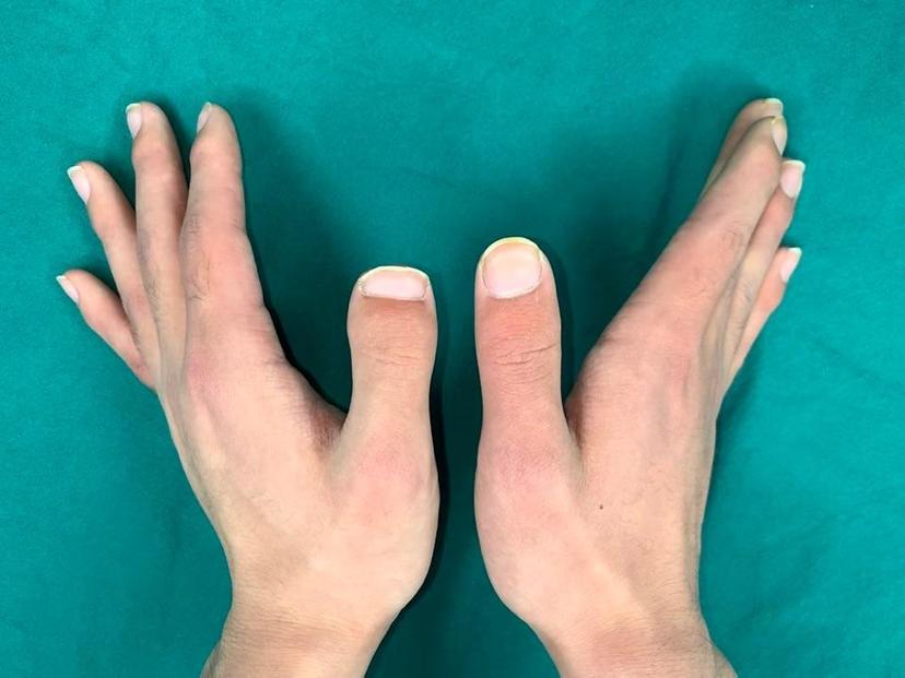 为什么我的大拇指又宽又短？ 微医（挂号网）